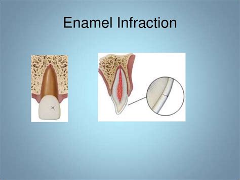 Ellis Class I And Ii Fracture