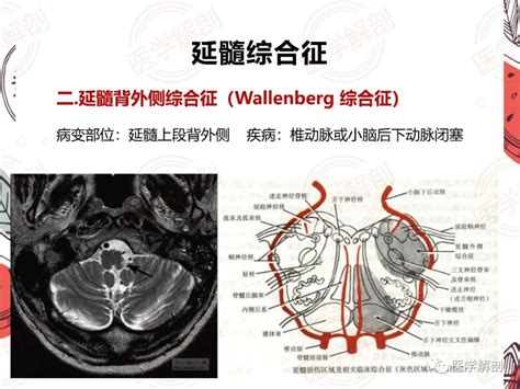 7大延髓综合征，清晰明了全总结！ 中国医疗