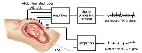 Figure 1 From Comparative Effectiveness Of Ica And Pca In Extraction Of Fetal Ecg From Abdominal