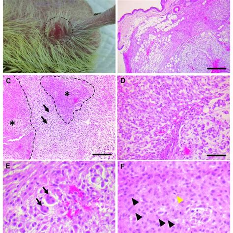 Pathological Observation Of The Pleomorphic Myxoid Liposarcoma A