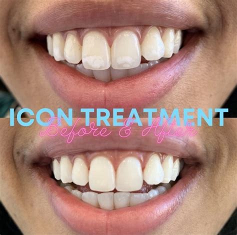How To Remove White Spots From Teeth Galloro Dental Group
