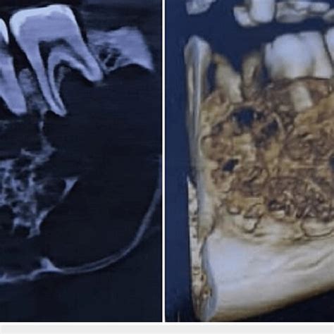 Multilocular Radiolucency With Honeycomb Appearance Download Scientific Diagram