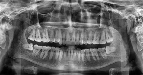 Opg Orthopantomogram Moses