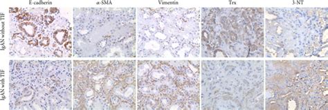 Expression Of Emt Markers E Cadherin α Sma And Vimentin And
