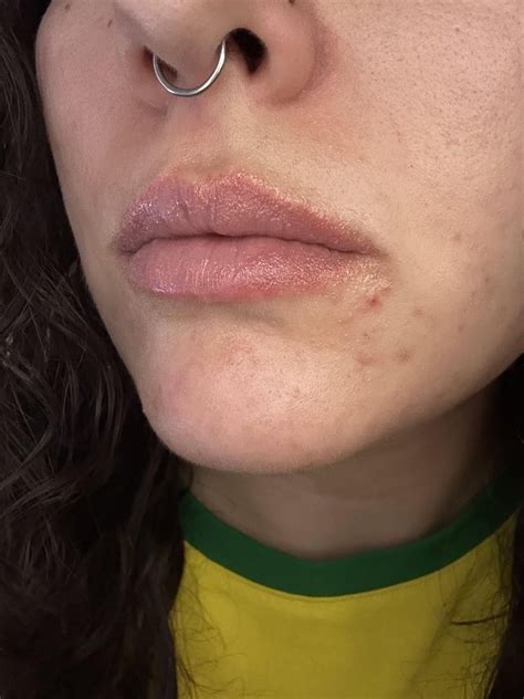 Lip Eczema Rdermatologyquestions