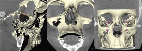 Infraorbital Canal