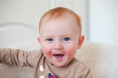 Quais as doenças de pele em bebês mais comuns Blog Granado Bebê