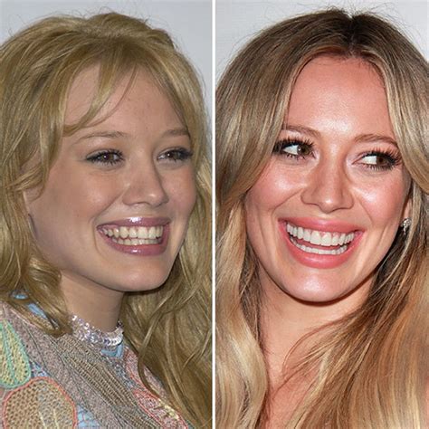 Hilary Duff Teeth Before And After 2026 The Ultimate Hollywood Smile