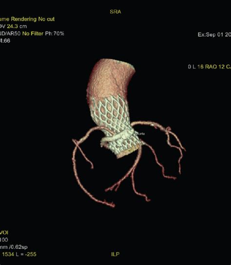 Six Month Follow Up Results After Tavr A Cardiac Computed Tomography Download Scientific