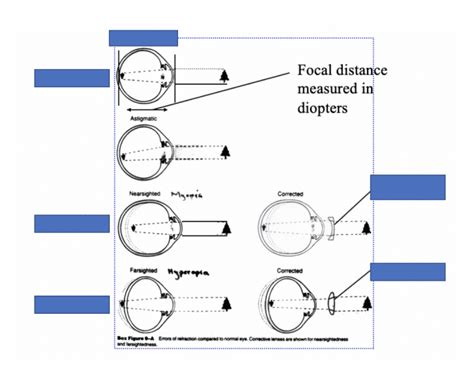 Emmetropia Myopia Hyperopia Quiz