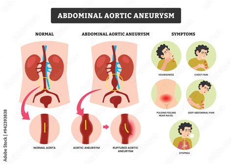 Abdominal Aortic Aneurysm With Symptoms Medical Poster Infographic Thoracic And Abdominal