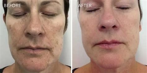 Gender Specific Responses To Led Skin Rejuvenation Skinimpact Led