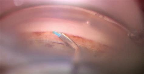Ideal Trabecular Meshwork Approach For The Omni Surgical System Eyetube
