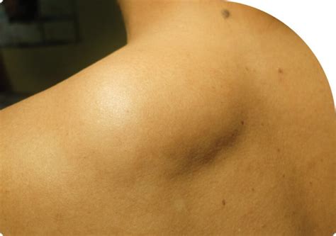 Soft Tissue Ultrasound Saddletown Ultrasound Ne Calgary