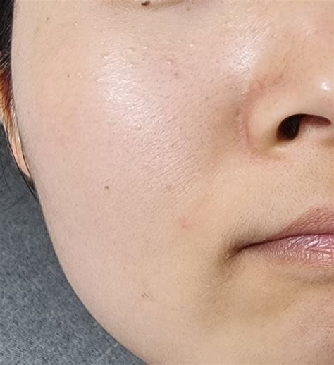 얼굴에 좁살같이 생긴게 생겼는데 피부과가면 치료되나요 지식in
