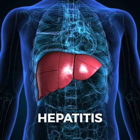 Hepatitis Overview Gastro Md
