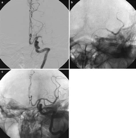 Acute Stroke Intervention Radiology Key