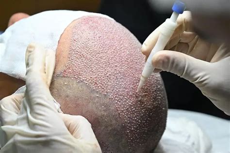 Greffe De Cheveux DHI Tunisie Guide Traitement Calvitie Masculine Et