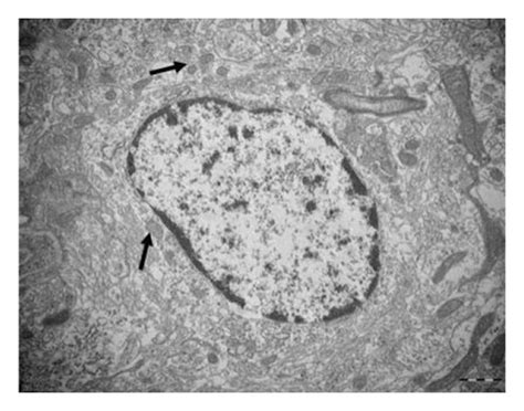 Microglial Ultrastructure In The Ischemic Penumbra Microglial