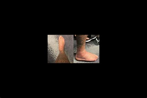 Neymar Compartilha Foto De Tornozelo Inchado Após Lesão