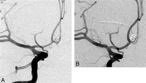 Embolization Of Intracranial Aneurysms With Hydrosoft Coils Results Of The Korean Multicenter