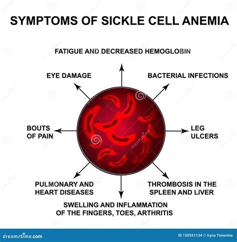 Sintomi Dell Anemia Faciforme Mondo Anemia Faciforme Giorno 19 Giugno