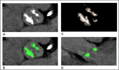 aortic valve calcification segmentation and measurement a