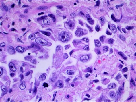 Sub Classifying Lung Cancer With Tensorflow 2 And Keras By Andrew A