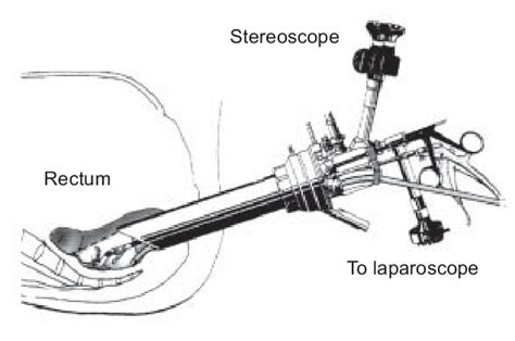 Instrument Setup Of Transanal Endoscopic Microsurgery Download Scientific Diagram
