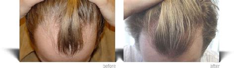 Ziering Medical Hair Transplant Reviews Beverly Hills Photos 1 Hair