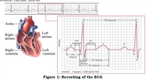 figure 1 from identifying arrhythmias based on ecg classification using