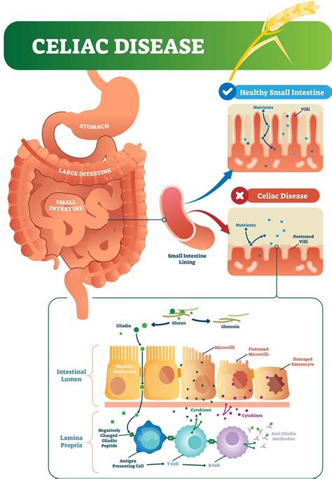 How To Read A Celiac Disease Panel Pelajaran