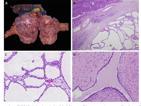 Figure 1 From Giant Symptomatic Serous Cystadenoma Mimicking Carcinoma