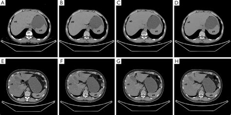 Measurement Of The Average Ct Attenuation Values Of The Liver And