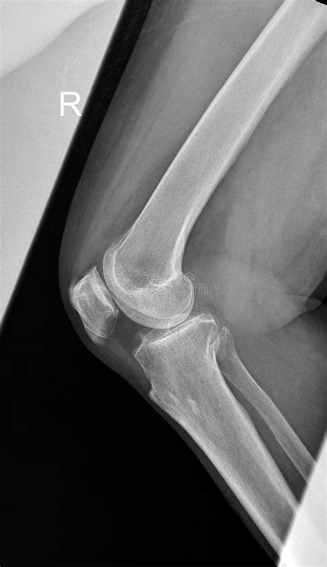 Anatomy Of The Knee Joint Of Lateral Radiograph Stock Image Image Of