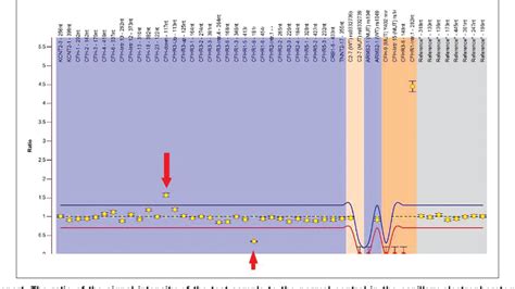 [pdf] Atypical Hus Associated With Cfh Cfhr 1 Hybrid Gene Semantic