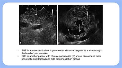 Chronic Pancreatitis Lab And Instrumental Diagnosispptx Free Download