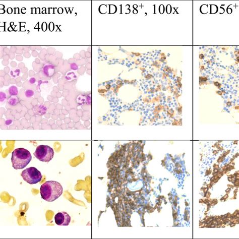 The Bone Marrow Bm Trephine Biopsy Sample Histopathological