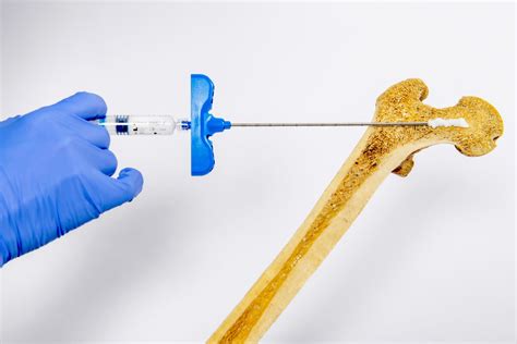 Injectable Bone Gel May Be A Radically Better Treatment For Osteoporosis