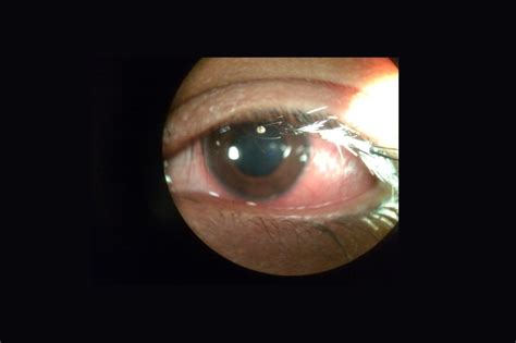 Red Itchy Eyes Are Year Round In Hawaii — Dr Rupa