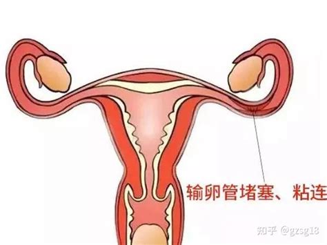 输卵管有问题，先治疗还是直接做试管？ 知乎