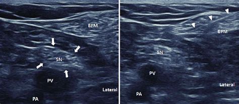 A 12 5 Mhz Transverse Ultrasound Image Just Above The Bifurcation Of