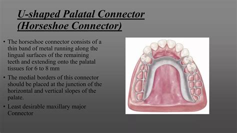 Maxillary Major Connectors Pptx