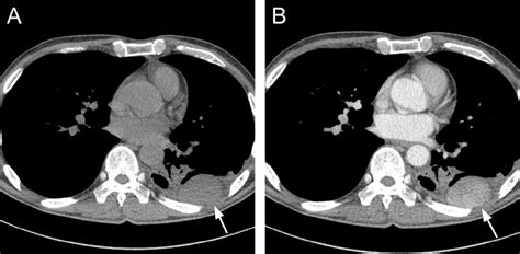 Contrast Enhanced Ct Of Pleural Castlemans Disease A Precontrast Ct Download Scientific