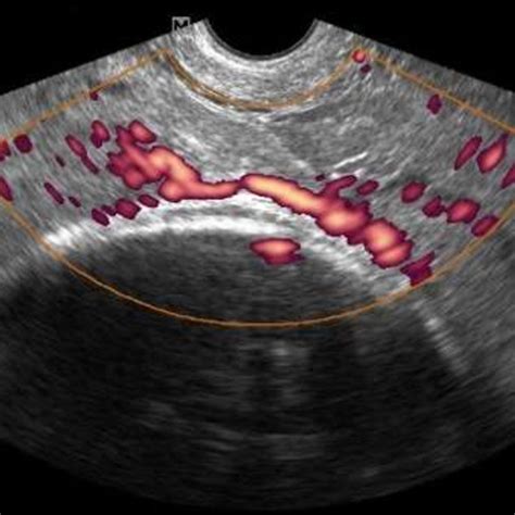 Pdf Antenatal Diagnosis Of Vasa Previa Report Of Three Cases In An