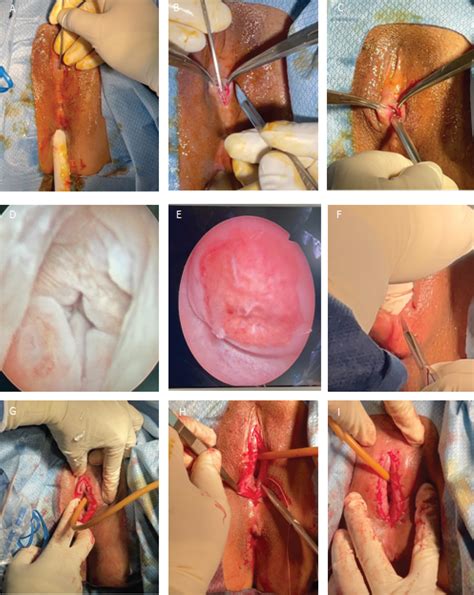 Labial Adhesions In Adults
