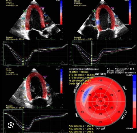 Écho Doppler Cardiaque Cardiologue Témara Dr Lagziri