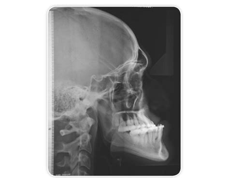 Pre Surgical Cephalogram Download Scientific Diagram