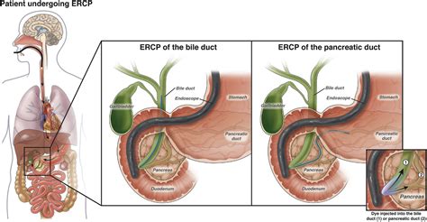 Endoscopic Retrograde Cholangiopancreatography Clinical