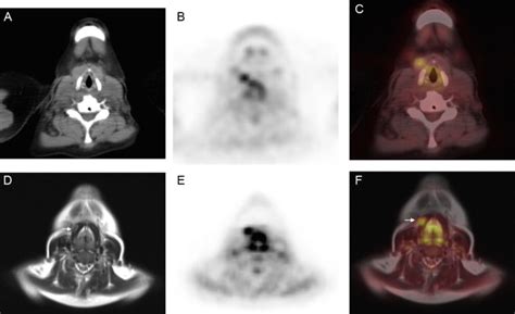 Status Post Thyroidectomy In A Patient With Elevated Thyroxine Binding Download Scientific